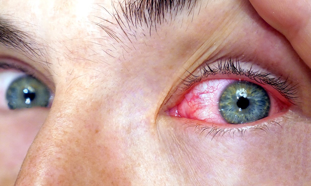 Maladies Oculaires Graves Trouble De Vision : Quelles Sont Les